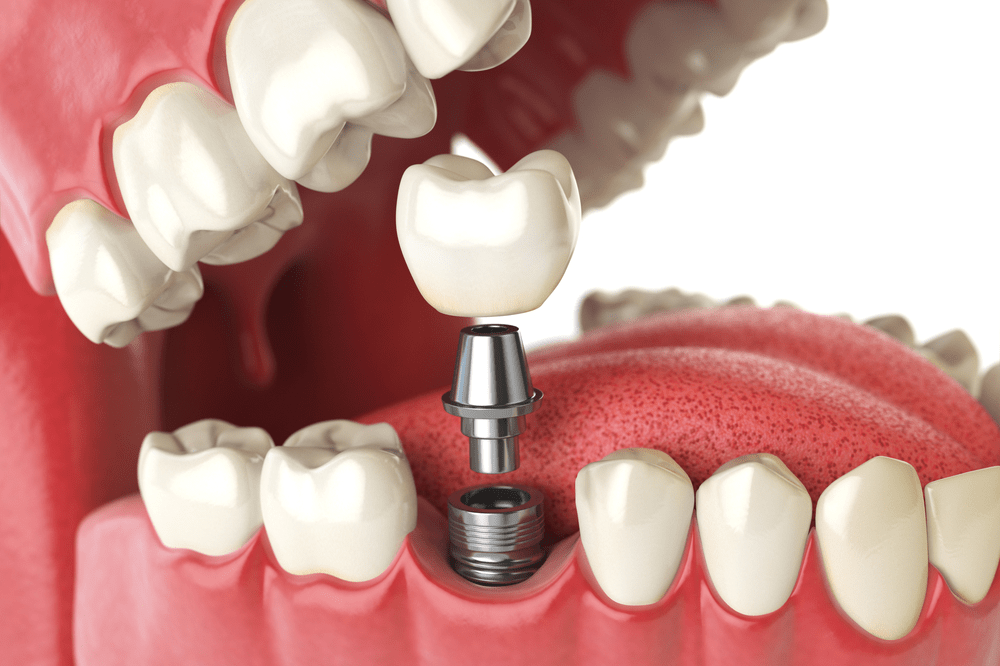 Dental Implants Can Prevent Bone Loss In The Jaw Dental Implants Can Prevent Bone Loss In The Jaw